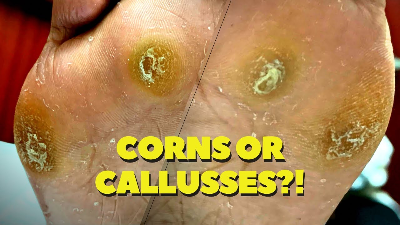 THICK, DEEP Seeded Corn and Callus Removal - YouTube