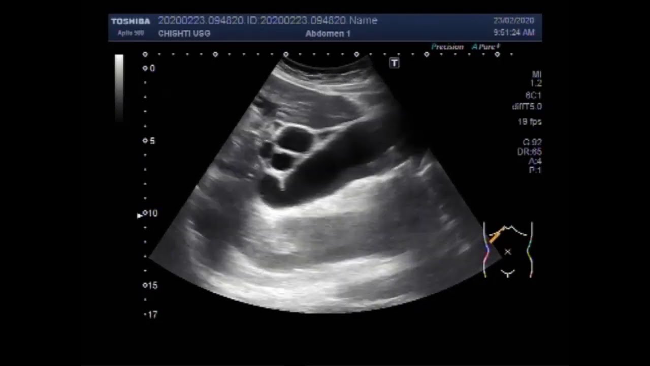 Ultrasound Video showing Cholelithiasis associated with ...