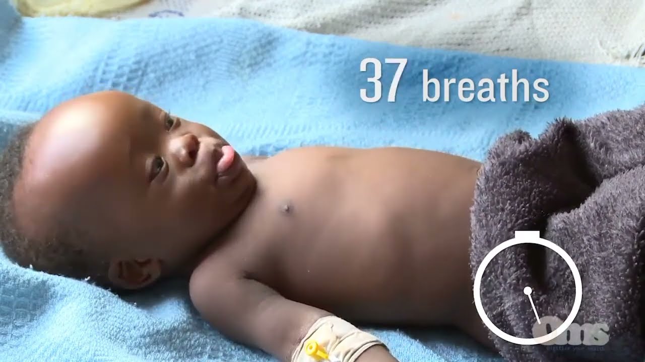 Chest indrawing child|SAM | Diagnosis Severe acute malnutrition ...