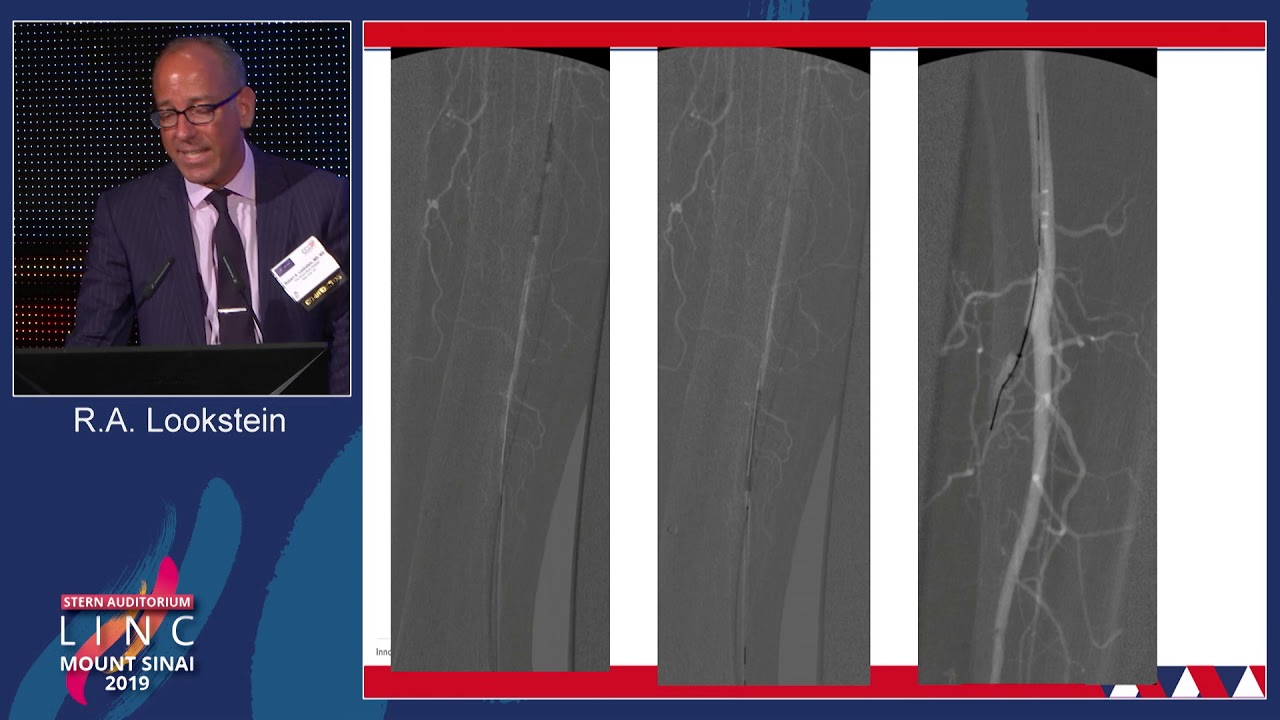 Stern D2 - Direct vs. Indirect Revascularization - Dr. Robert Lookstein ...