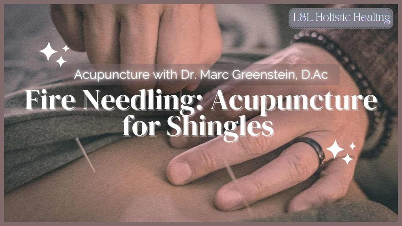 Fire Needling: Acupuncture for Shingles - YouTube