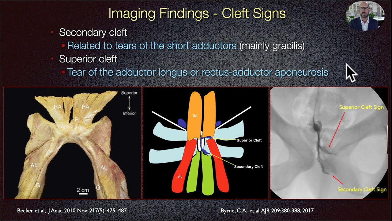 Groin Pain in Athletes - 10 Minute Version - YouTube
