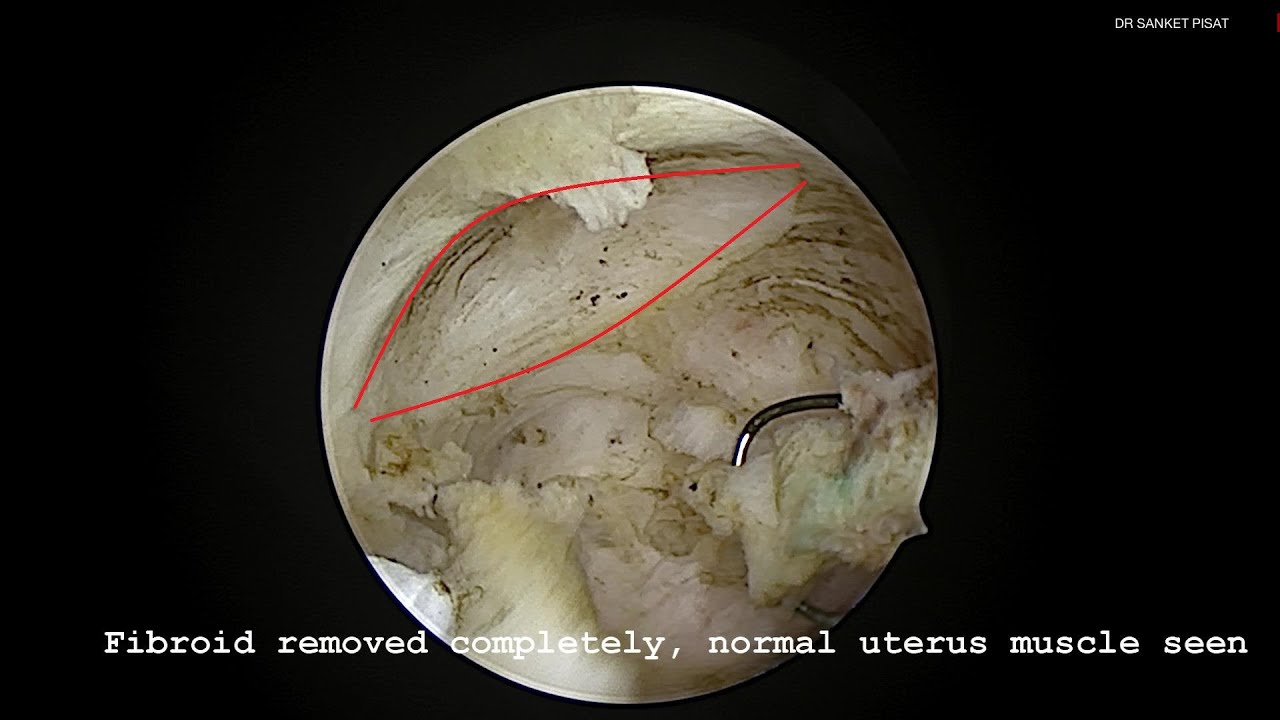 Patient Info video: Hysteroscopic fibroid removal (myoma resection ...
