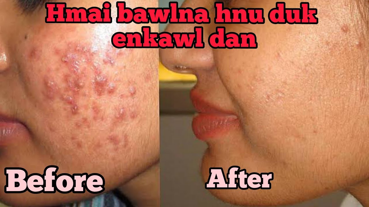 hmaibawl na hnu ser dum ti reh dan // dark spots tireh dan // vun ngona ...
