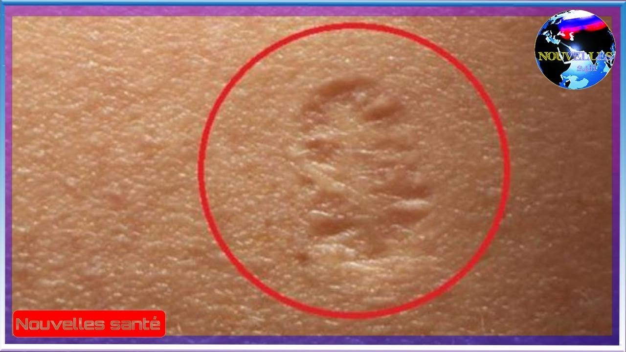 Nous avons tous cette petite cicatrice sur le bras. Voici sa ...
