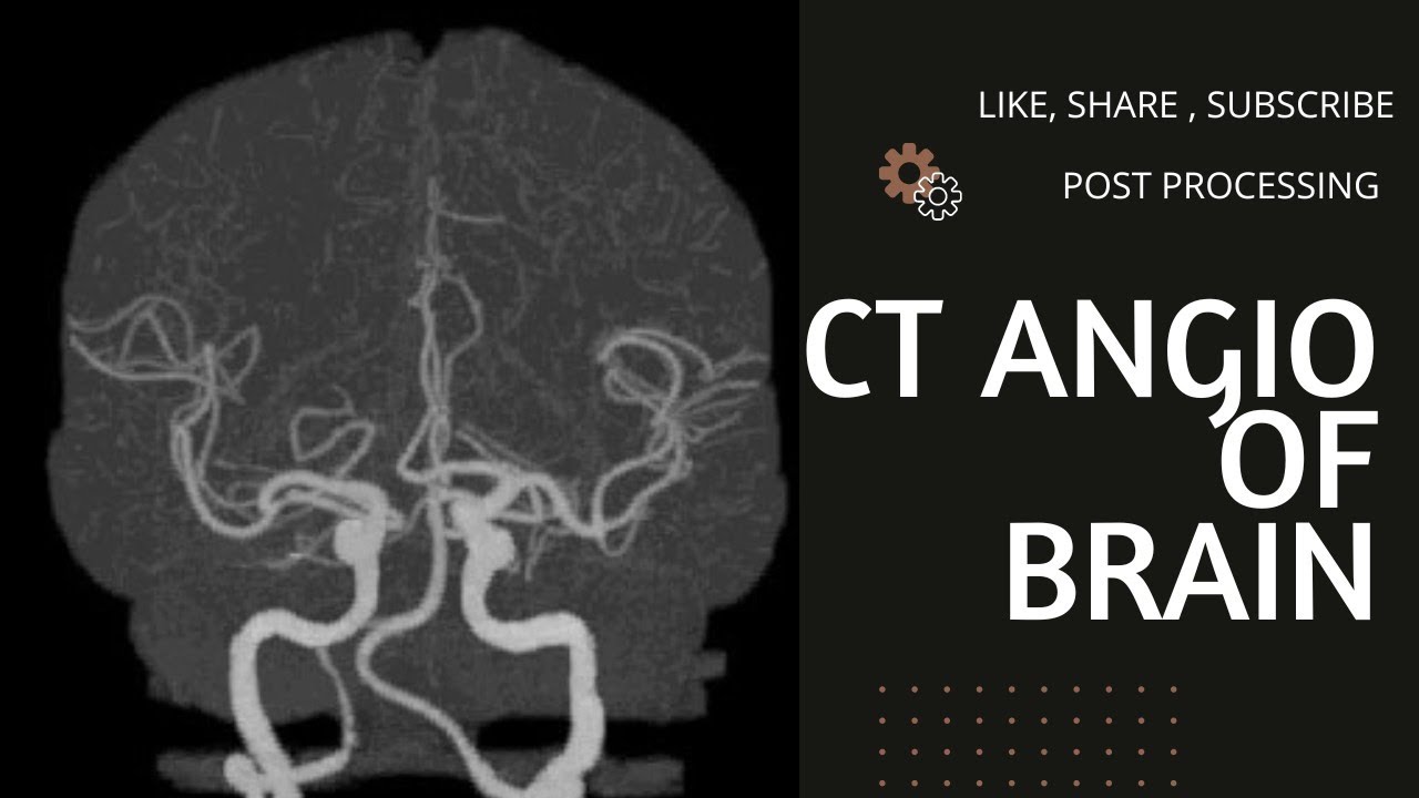 CT Angiography Brain Post Process of Filming. - YouTube