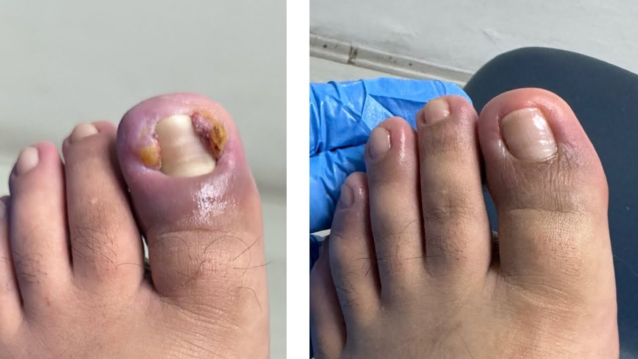 RESULTADOS DE UNA MATRICECTOMIA #ingrown_toenail_surgery - YouTube