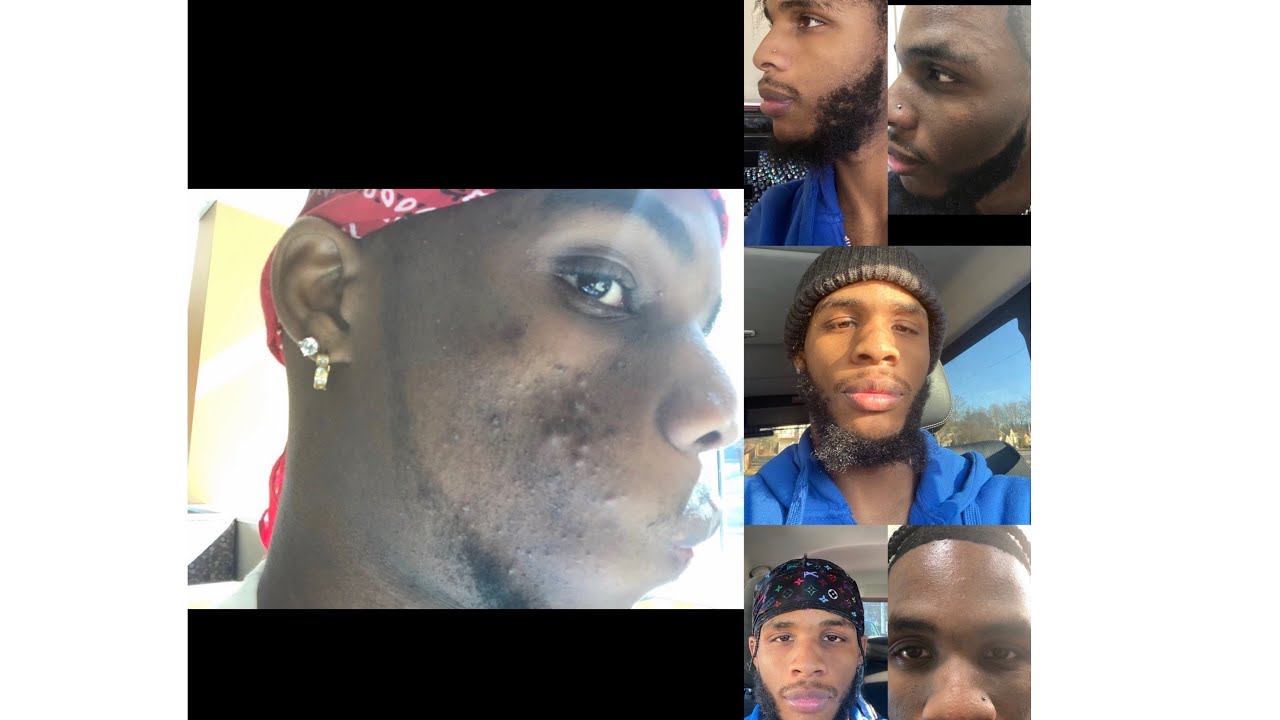 HOW I CLEARED MY ACNE AND HYPERPIGMENTATION!!! (UNBELIEVABLE) - YouTube