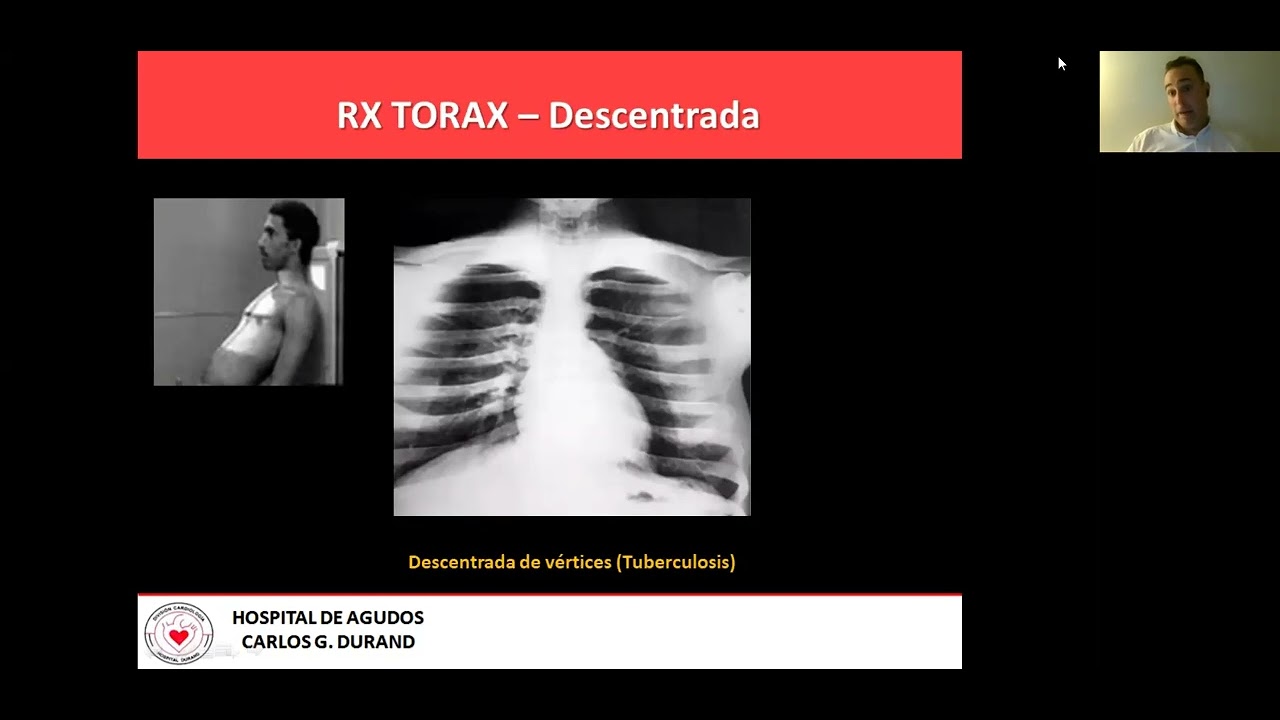RX TORAX TÉCNICA - YouTube