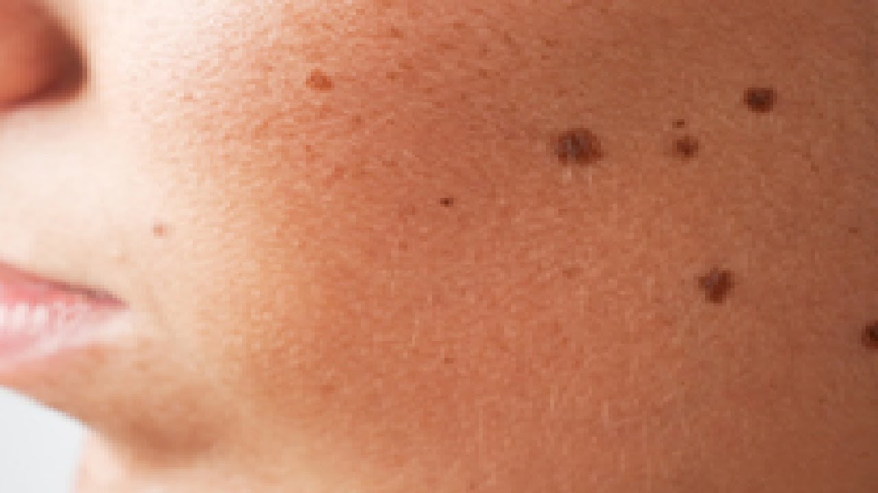 how to get rid of moles on face without scarring - YouTube