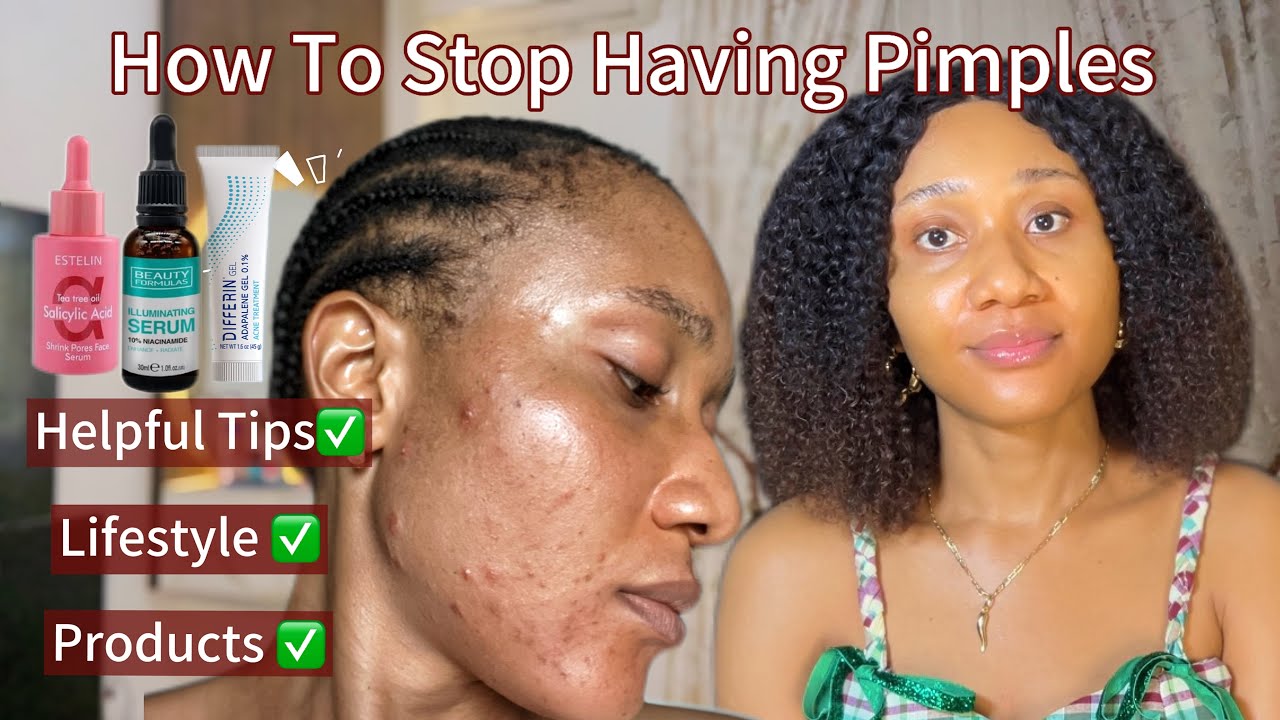 Do these to stop having pimples how to get clear skin,oily skin,how to ...