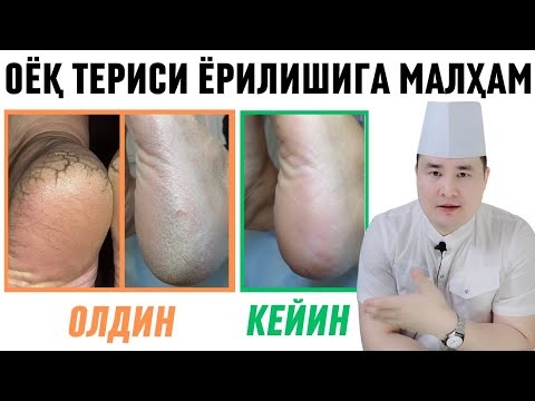 ОЁҚ ТЕРИСИ ҚУРШАБ ЁРИЛИШИГА УЙ ШАРОИТИДА ДАВО ЧОРАЛАРИ / Исчанов