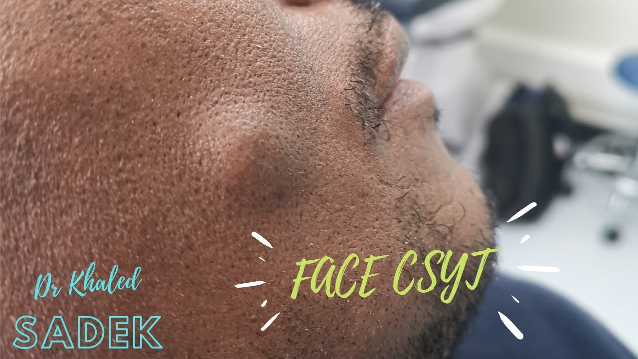 Massive Face Cyst. DR Khaled Sadek. LipomaCyst.com - YouTube