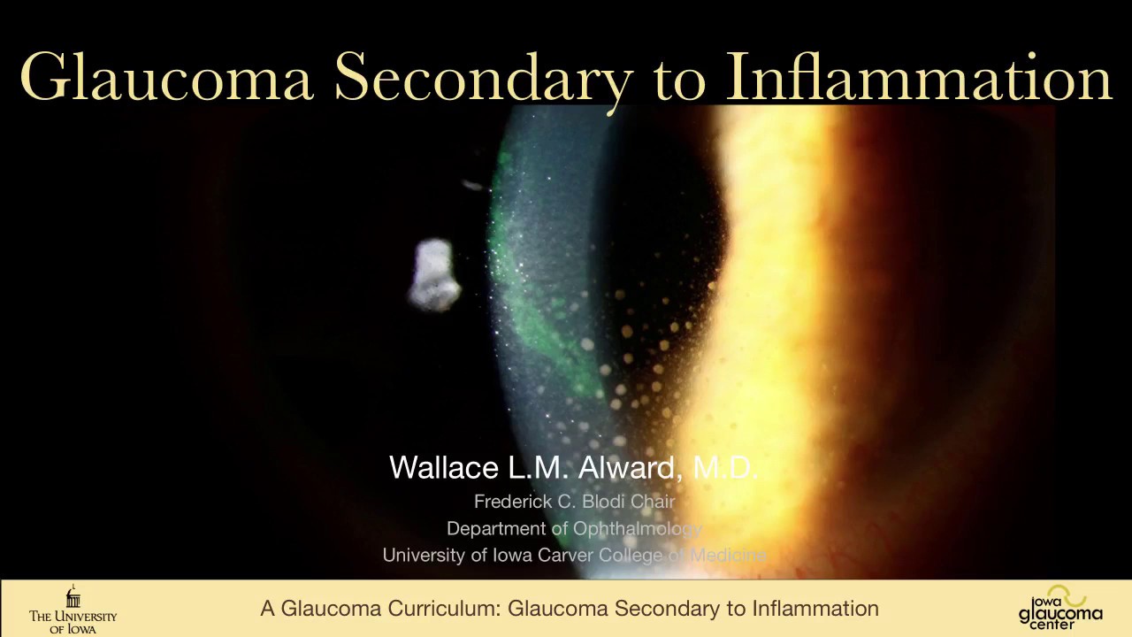 Glaucoma secondary to inflammation - YouTube