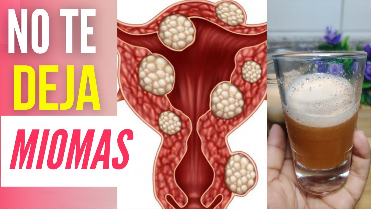 Miomas y FIBROMAS Síntomas Tratamiento como Curar/Cómo eliminar miomas ...