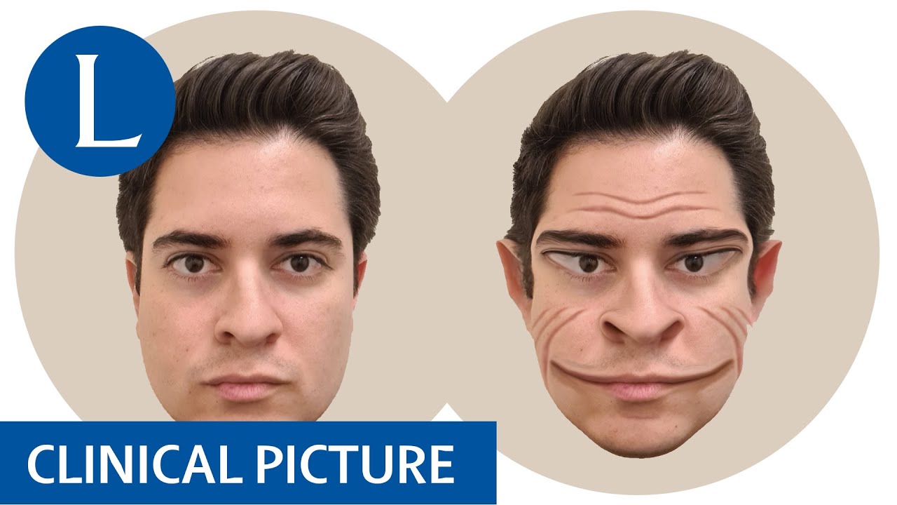 Visualising facial distortions in prosopometamorphopsia - YouTube