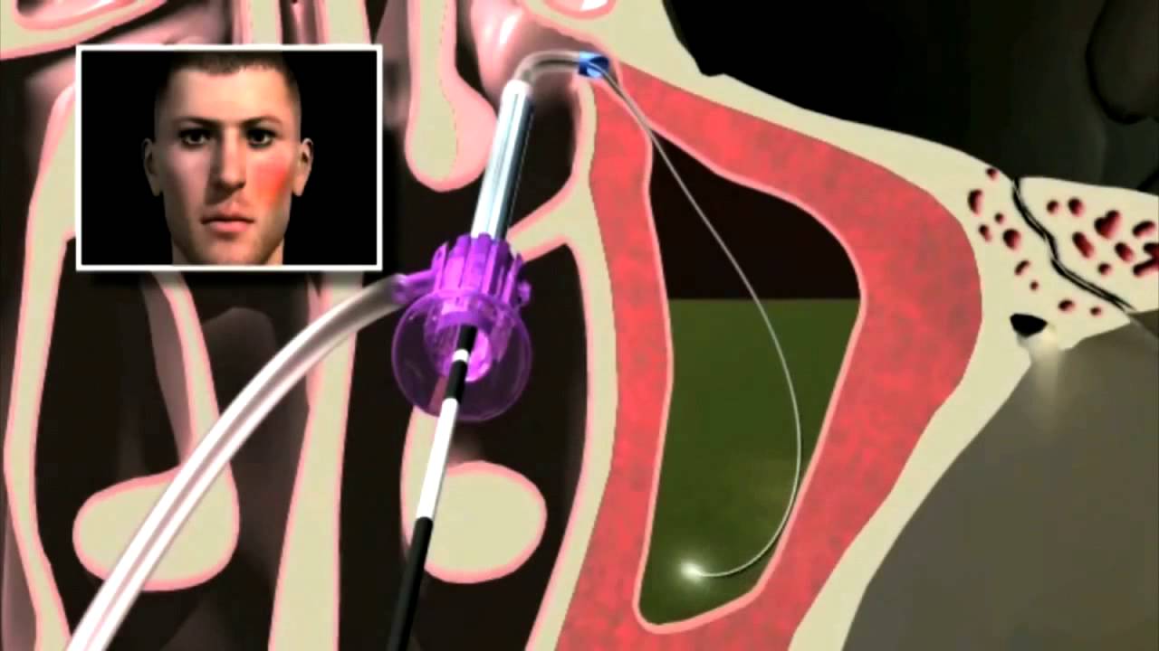 Balloon Sinus Dilation on CBS - YouTube