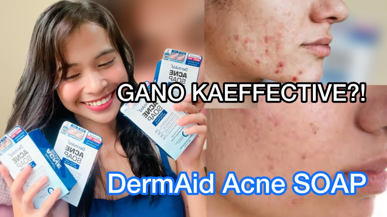 Dermaid Acne Soap REVIEW! (YOU MUST TRY!😱) - YouTube