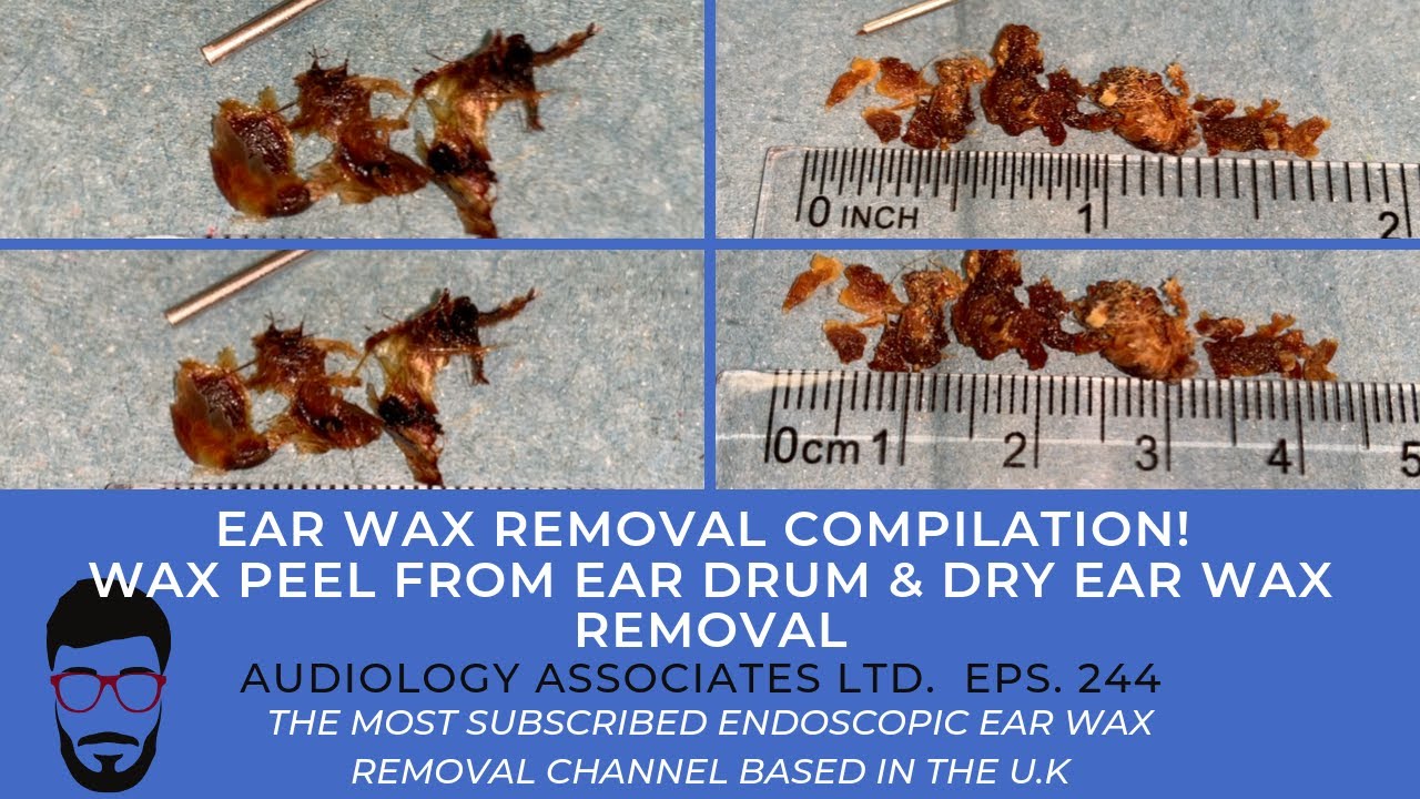 Ear Wax Removal Compilation Wax Peel From Eardrum And Dry Ear Wax Removal Ep 244 Youtube