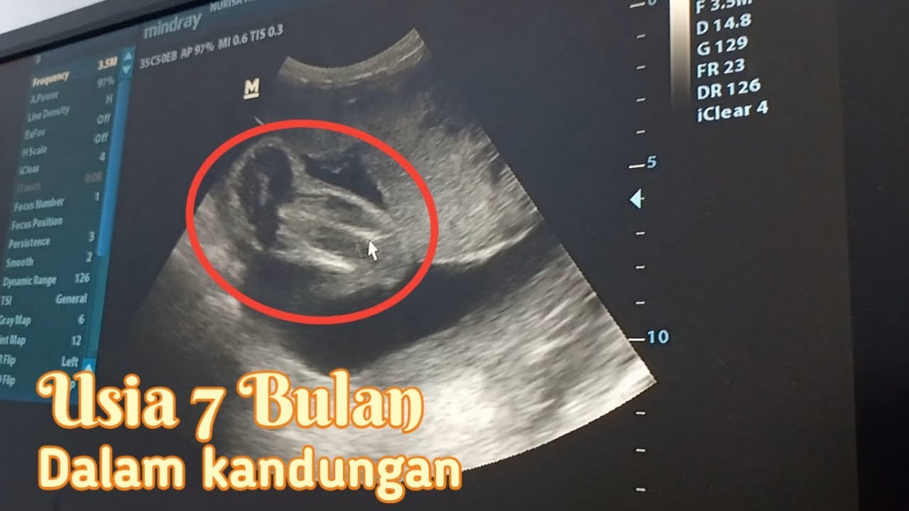 Kondisi Janin usia 7 bulan di dalam rahim - YouTube