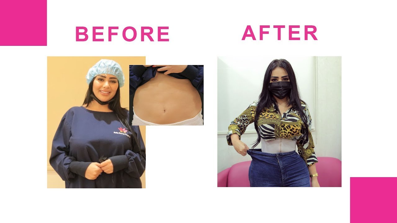 Liposuction in Bella Roma Hospital - YouTube