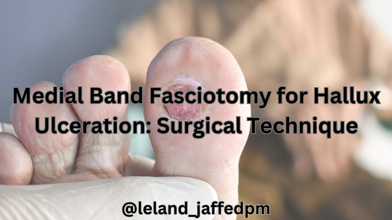 Medial Band Fasciotomy for Hallux Ulceration: Surgical Technique - YouTube