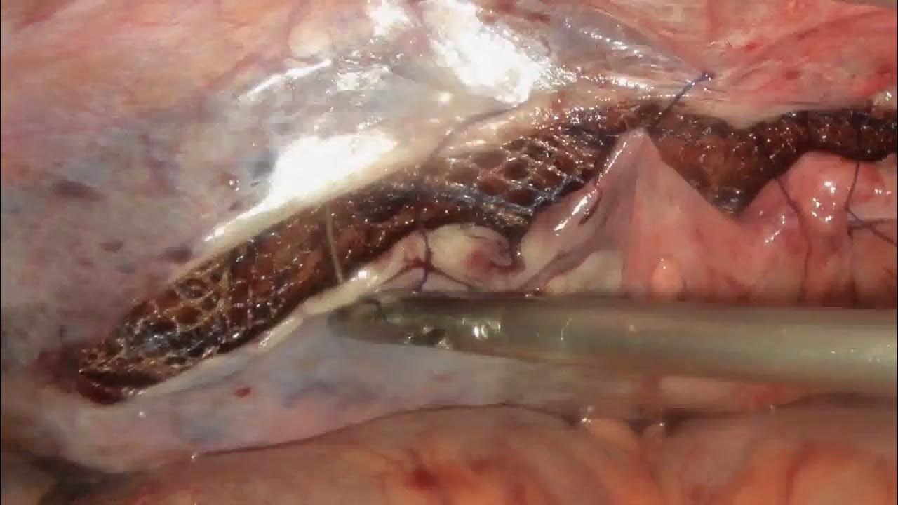 Laparoscopic Inguinal Hernia Repair (TAPP 9 , TAPP Plus ) - YouTube