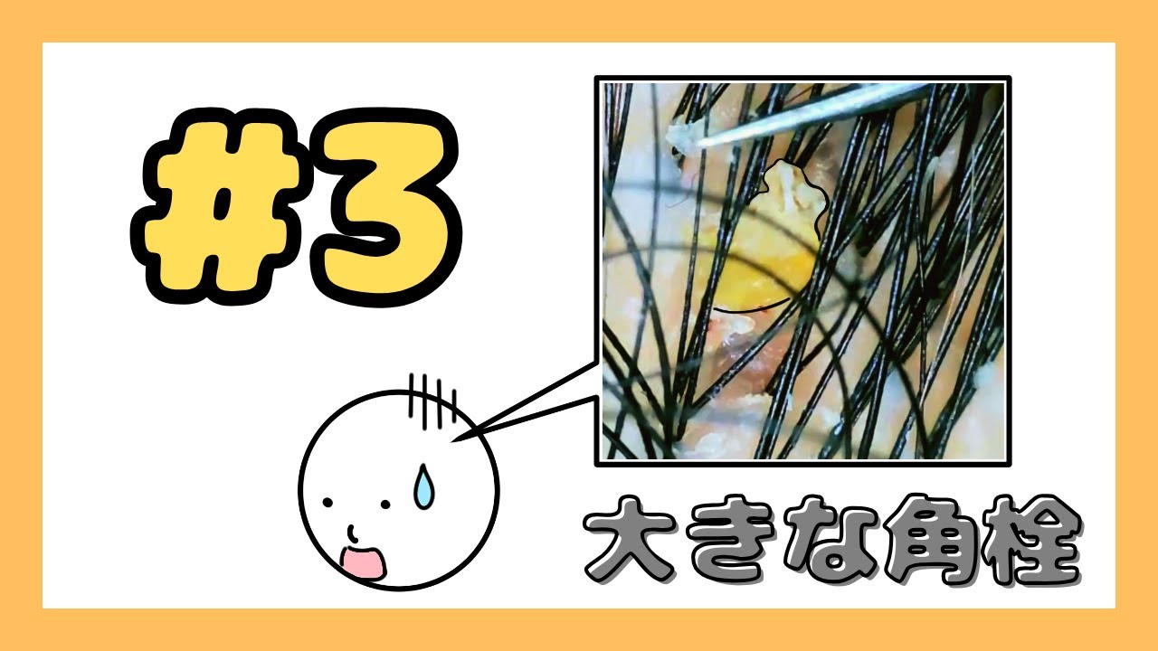 #3 3つの毛穴にまたがる大きな角栓 / Large Sebum Plug on Scalp - YouTube