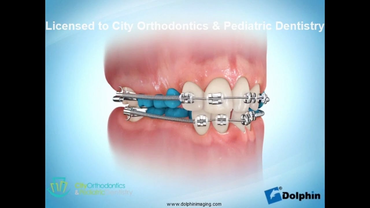 Partial Braces with Springs - YouTube