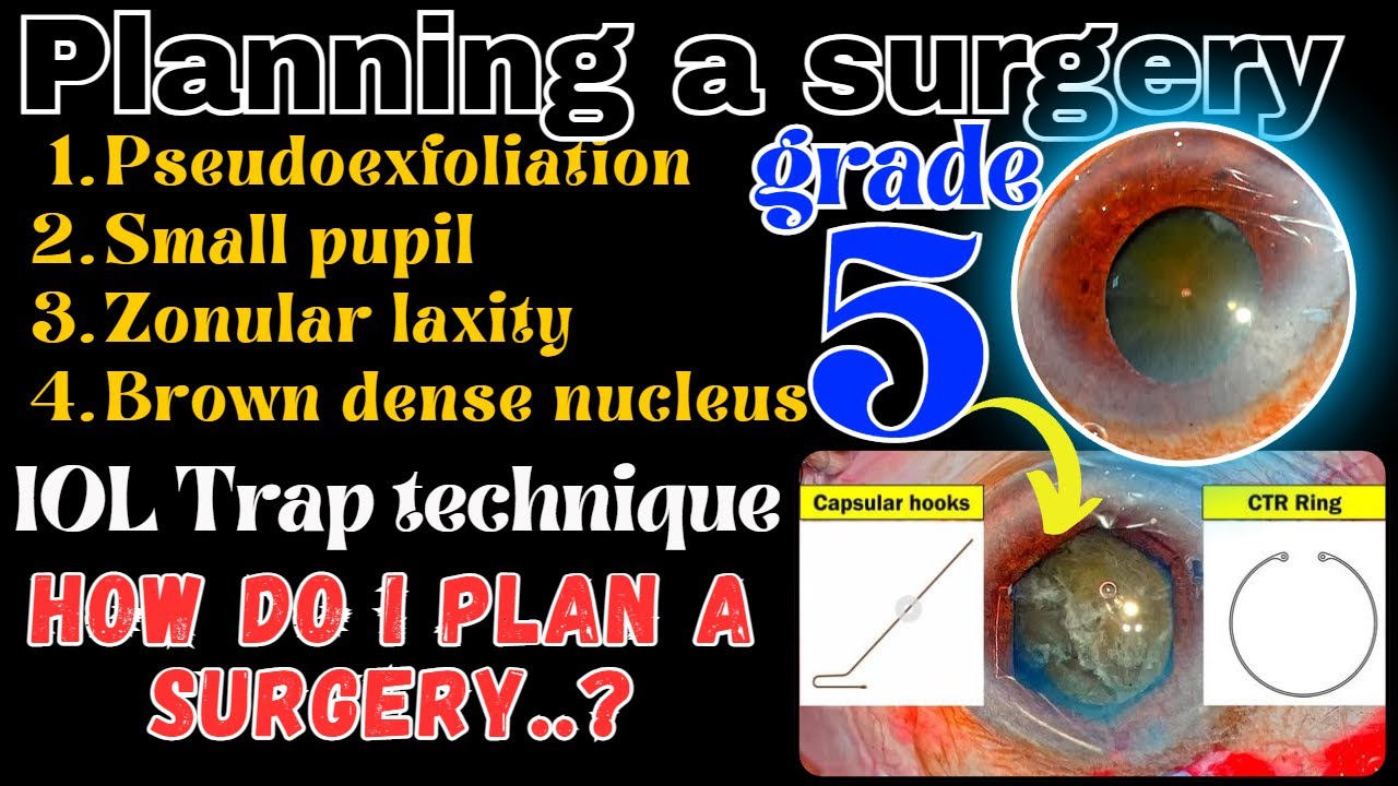 Tough Cataract,Weak Zonules ,Hard Cataract,Pseudoexfoliation-IOL Trap ...