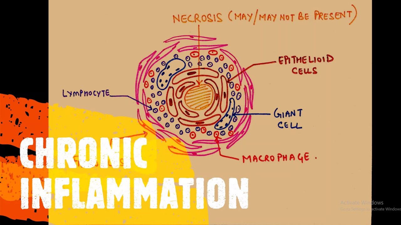 GENERAL PATHOLOGY II CHAPTER 3 II INFLAMMATION II CHRONIC INFLAMMATION ...
