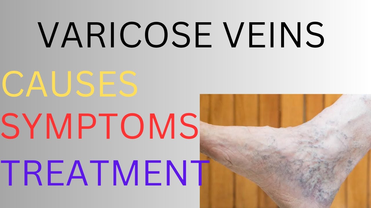 Understanding Varicose Veins Causes Symptoms And Treatment Options