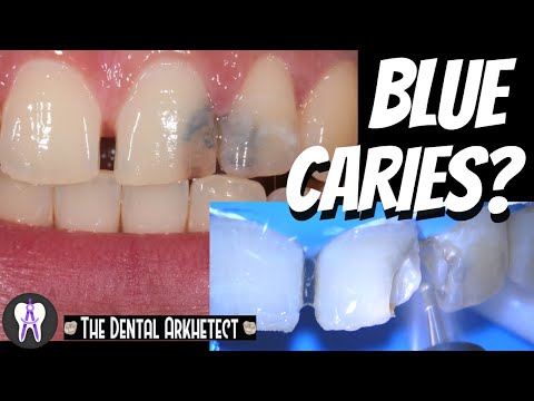 AMAZING Tooth Restoration w/ Gap Closure #C36 #4k