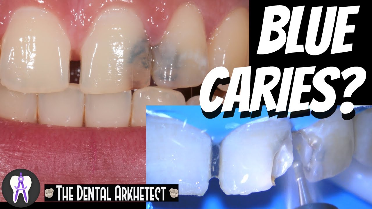 AMAZING Tooth Restoration w/ Gap Closure #C36 #4k - YouTube