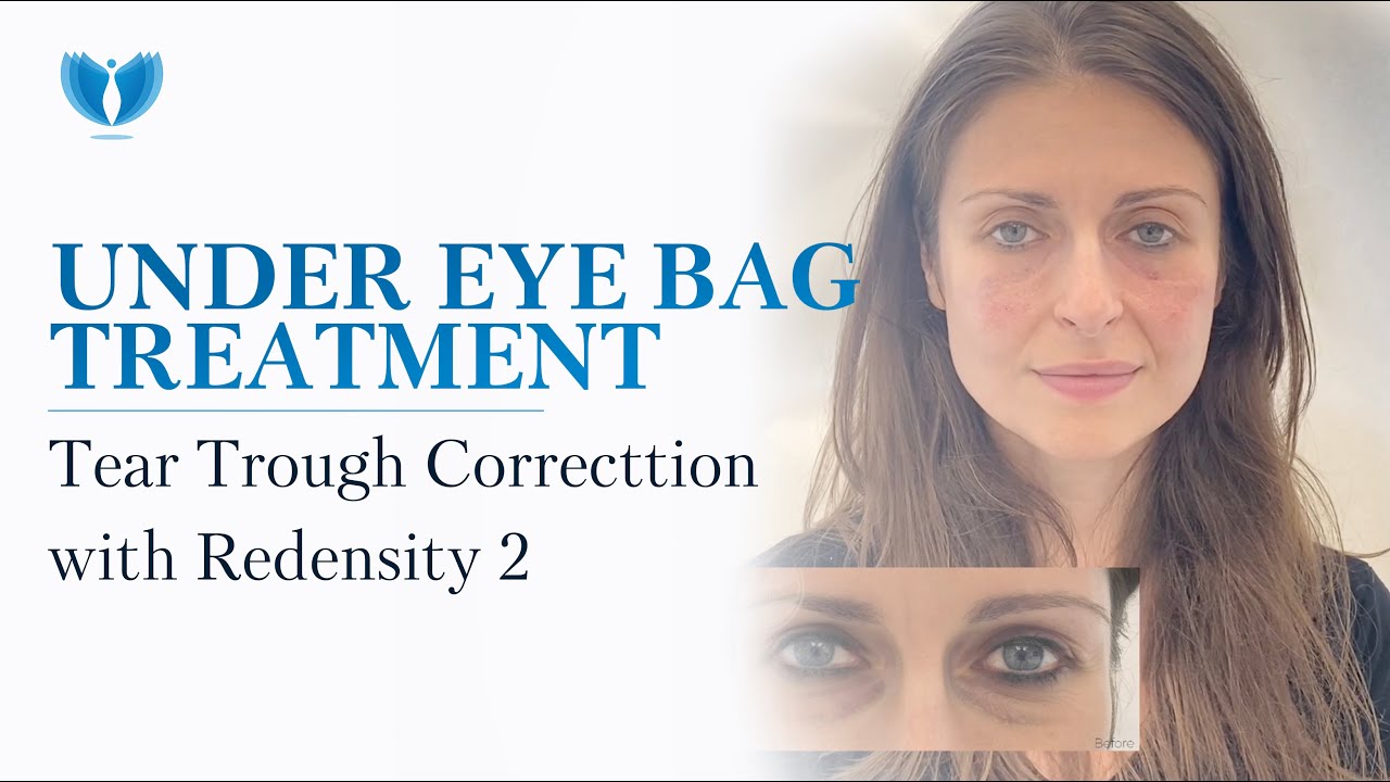 Tear Trough Treatment - Under Eye Area Correction with Dermal Filler ...