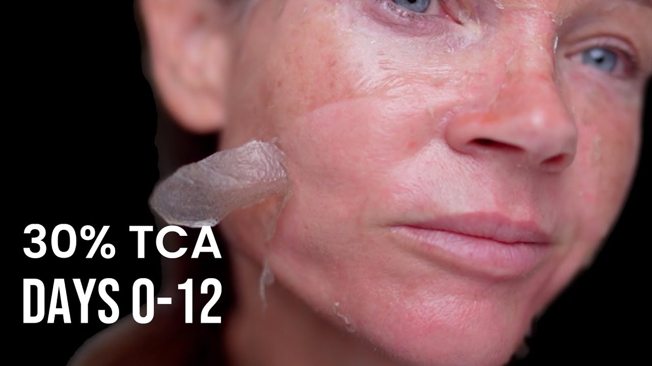 30 TCA Peel Full Demo | Real Time Application & Layering Process - YouTube