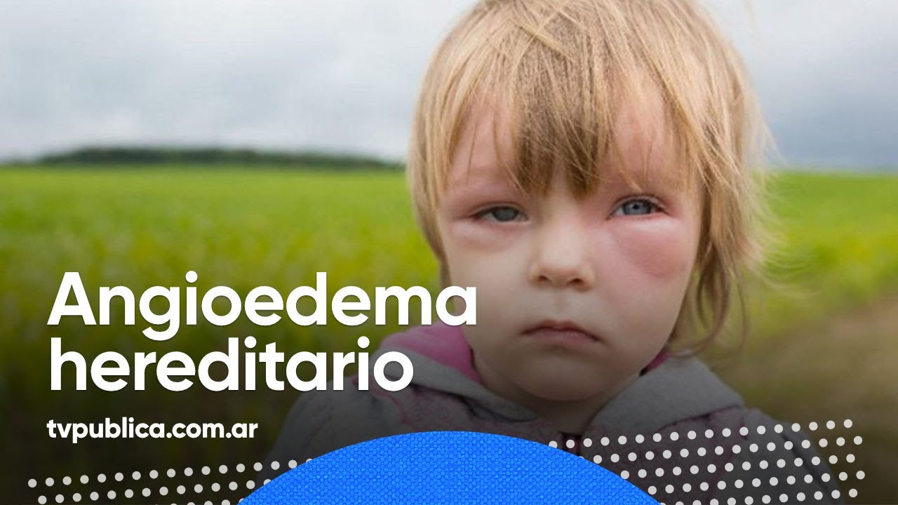 ¿Qué es el angioedema hereditario? - En Casa Salud - YouTube