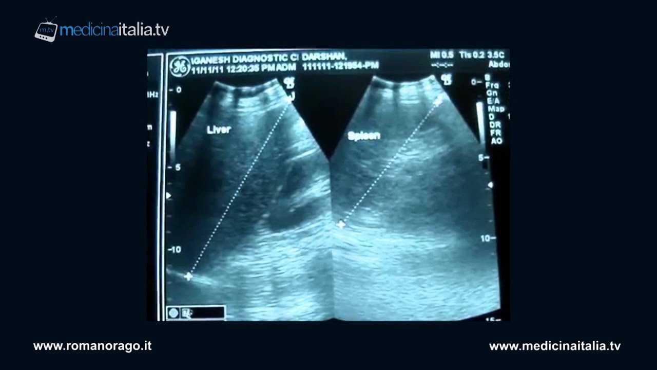 Prof. Romano Rago - Ematuria: sangue nelle urine - YouTube
