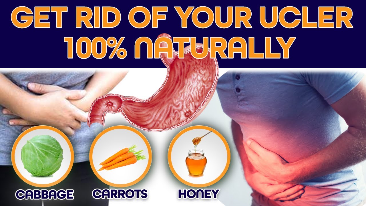 GET RID OF YOUR ULCER 100% NATURALLY - STOMACH ULCER REMEDY - YouTube