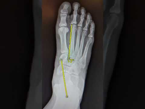 before and after Hyprocure surgery xray findings - YouTube