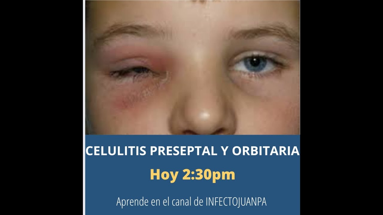 Celulitis preseptal y orbitaria - YouTube
