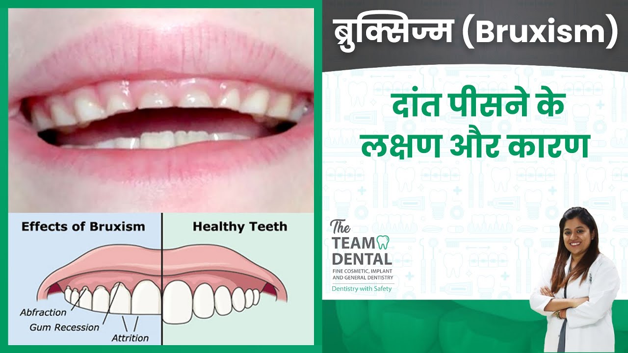 ब्रुक्सिज्म (Bruxism) दांत पीसने के लक्षण और कारण | The Team Dental ...