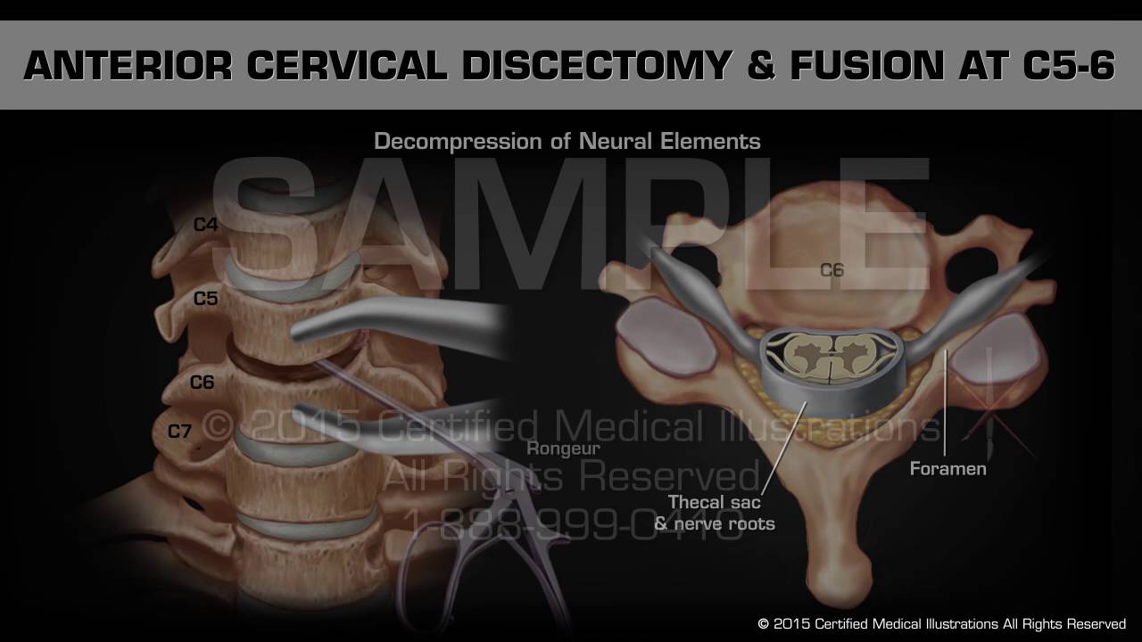 Anterior Cervical Discectomy & Fusion at C5-6 - YouTube
