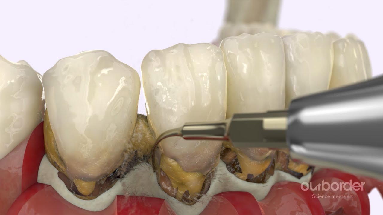 Periodontal Flap Surgery Animation l 치은박리소파술 - YouTube