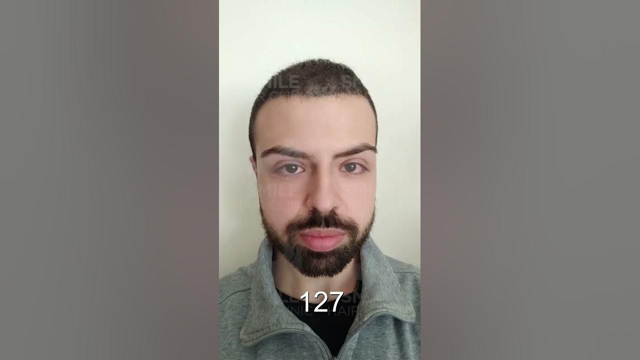 Hair Transplant Time Lapse - Day 1 to Day 347 - 1 Year Result - YouTube