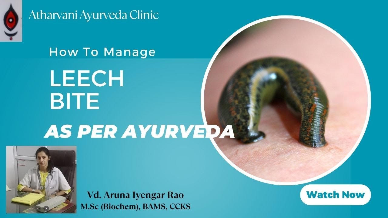 Leech-Jalouka-Ayurveda Panchakarma-How to manage Leech Bite - YouTube