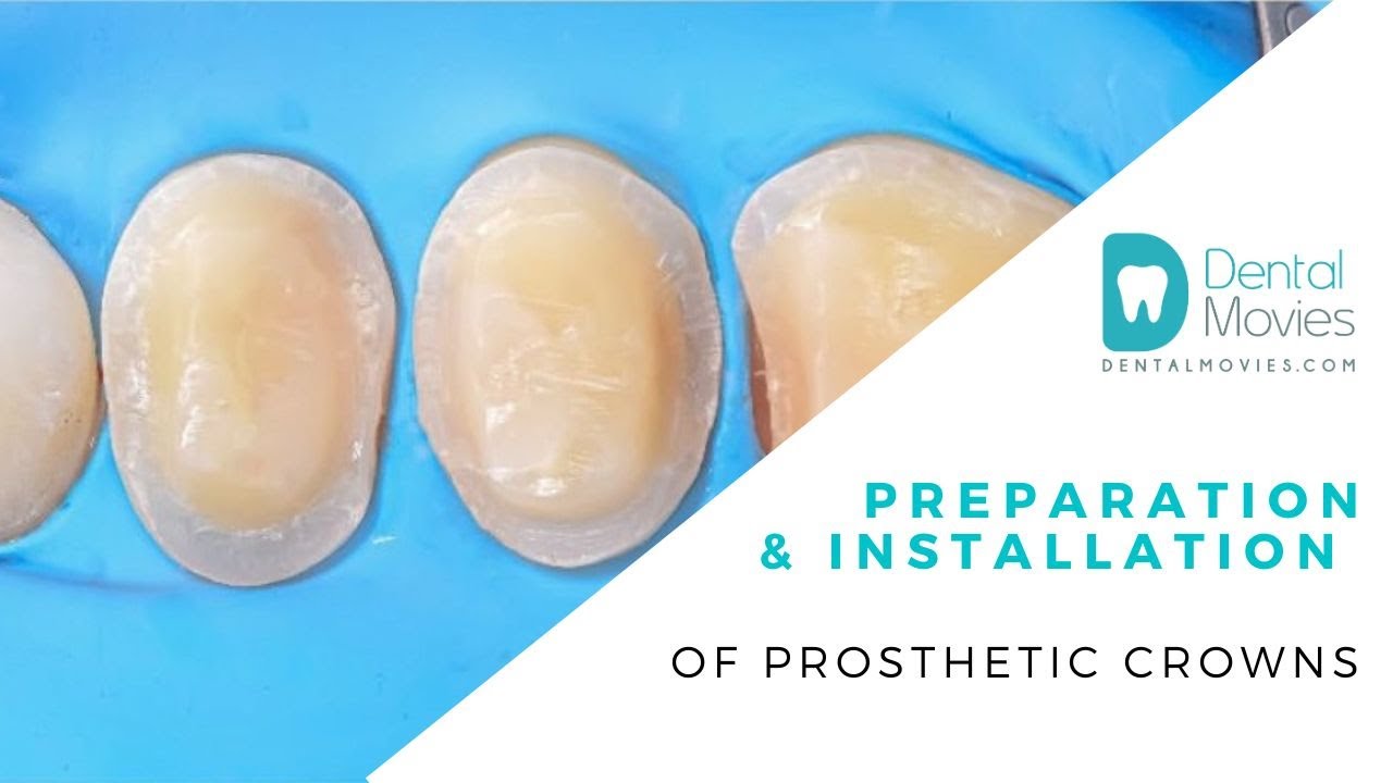 Preparation & installation of prosthetic crowns - YouTube