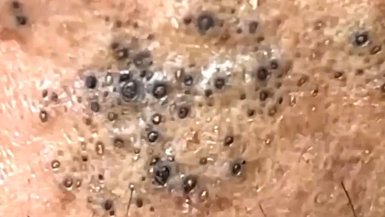 POINTS NOIRS ENORMES BLACKHEADS RELAX SKINCARE #satisfyingvideo - YouTube