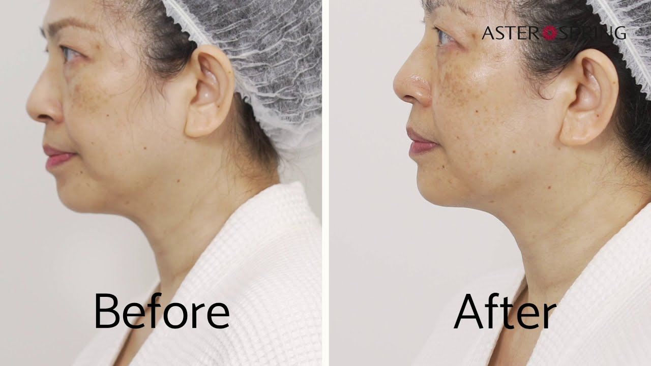 AsterSpring Volumizing Face Therapy Teaser - YouTube