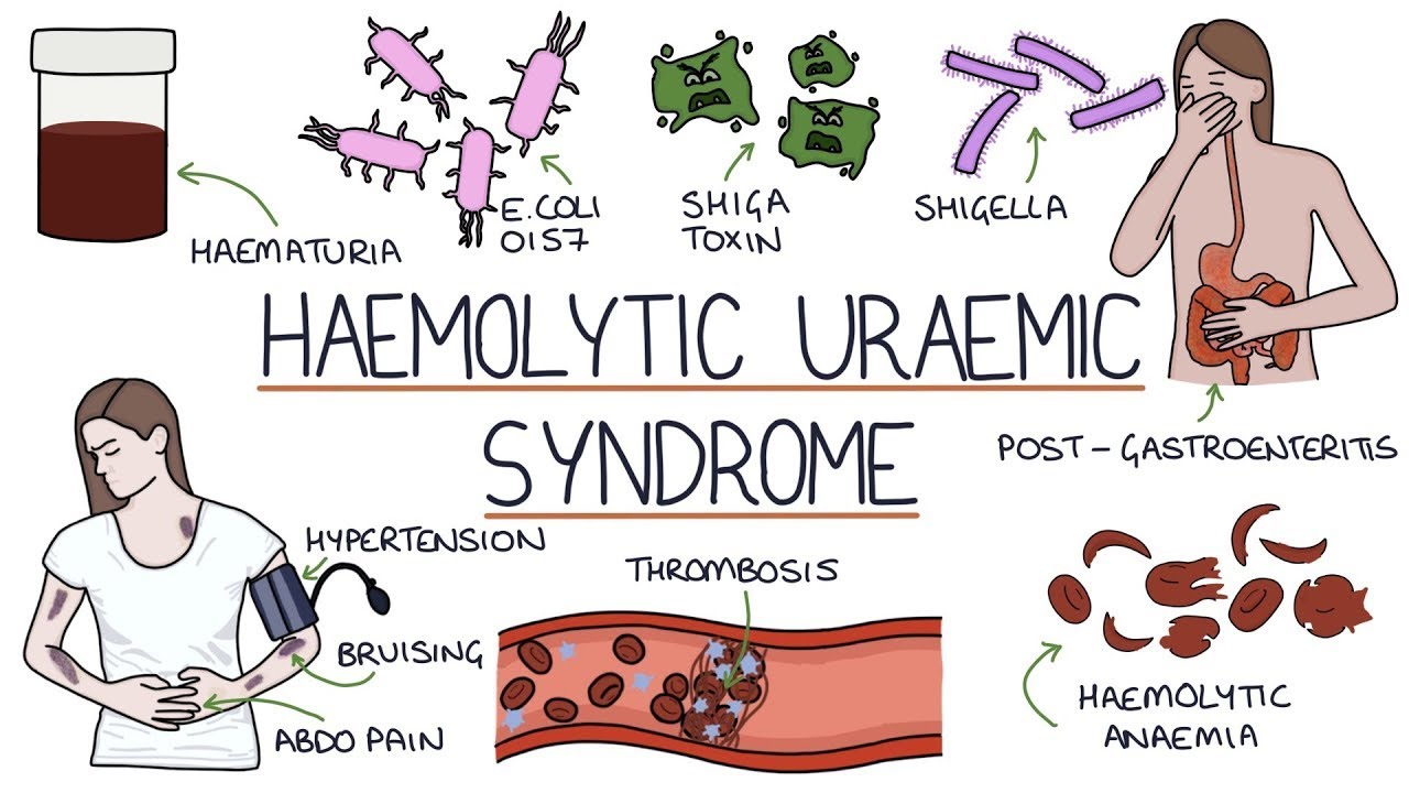 Hemolytic–uremic syndrome - YouTube